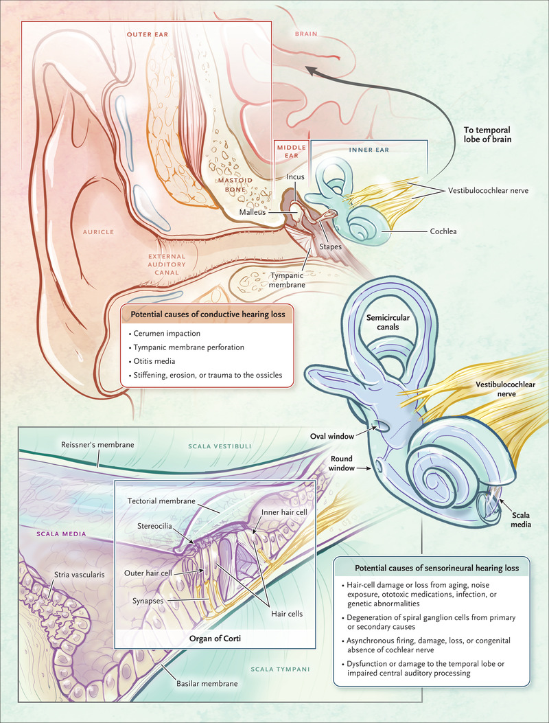 New Article on Cochlear Implantation in Adults | Adult Hearing